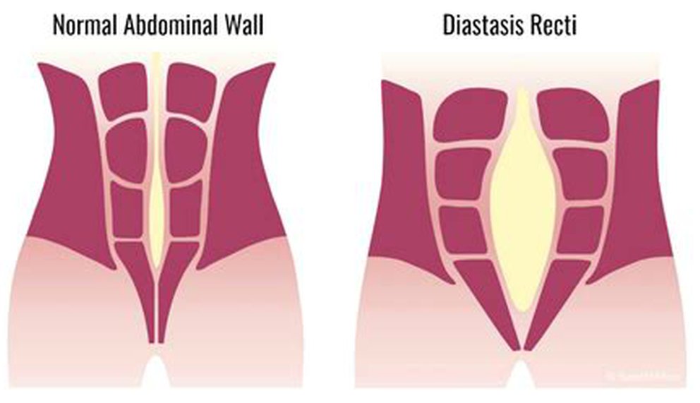 Was ist eine Diastasis Recti (DR)